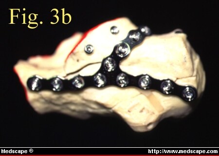 Fractures of the Os Calcis