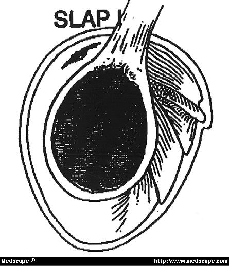 Sports Medicine Feature - The Recognition and Treatment of Superior ...