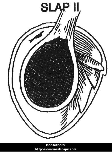 Sports Medicine Feature - The Recognition and Treatment of Superior ...