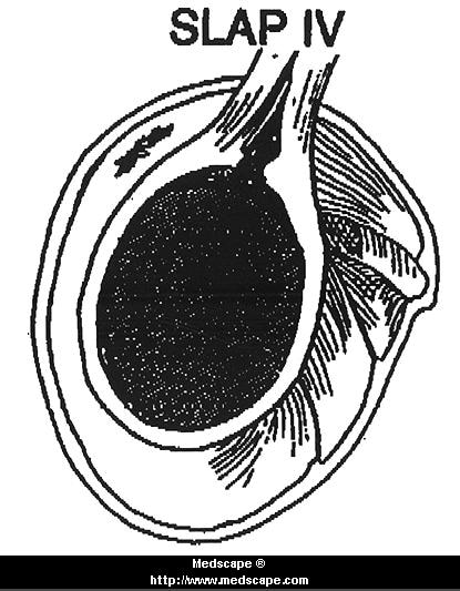 Sports Medicine Feature - The Recognition and Treatment of Superior ...