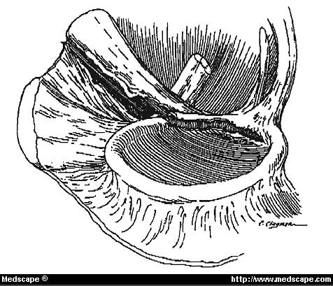 Sports Medicine Feature - The Recognition and Treatment of Superior ...