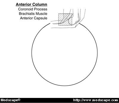 Restoring Elbow Stability After Fracture-Dislocation Part I: Elbow ...