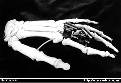 Treatment of Hand Fractures with External Fixation - Page 2