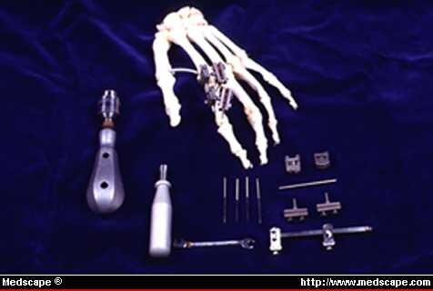 Treatment of Hand Fractures with External Fixation - Page 2