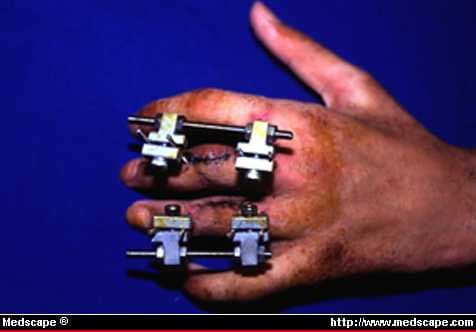 Treatment of Hand Fractures with External Fixation - Page 2