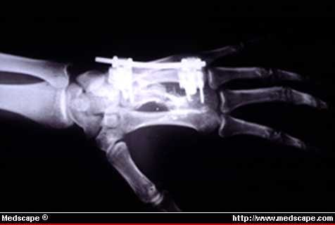 Treatment of Hand Fractures with External Fixation - Page 2