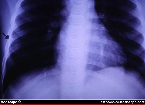 Needle Biopsies of Bone Tumors - Page 6