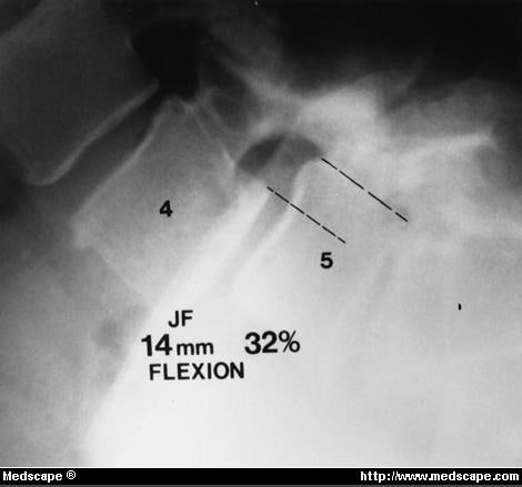 The Diagnosis and Management of Degenerative Lumbar Spondylolisthesis