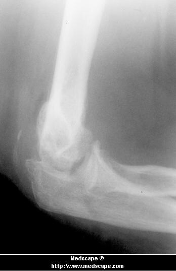 The Role of the Compass Elbow Hinge in the Operative Treatment of ...