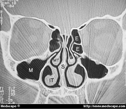 Sinusitis: A Practical Guide for Physicians - Page 6