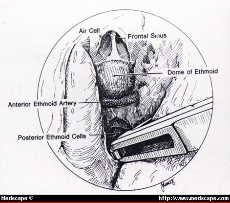 Sinusitis: A Head and Neck Surgeon's Perspective - Page 5