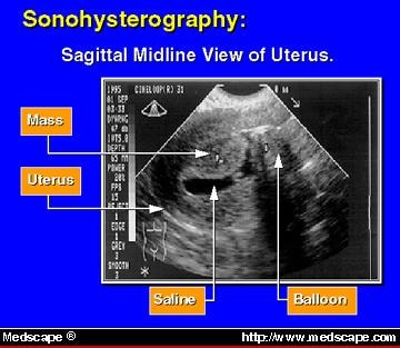 Contemporary Concepts in Managing Menorrhagia - Page 5