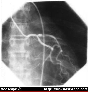 Treating CAD with Cardiac Surgery Combined with Complementary Therapy