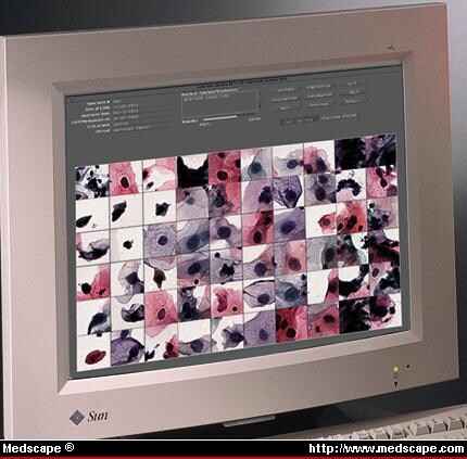 Innovations in Pap Screening for Cervical Neoplasia - Page 5