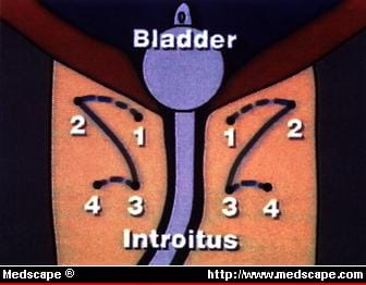 Percutaneous Bladder Neck Stabilization for Stress Urinary Incontinence ...
