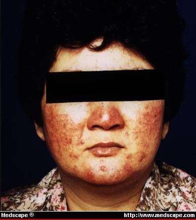 Clinician's Photo Guide To Recognizing and Treating Skin Diseases in ...