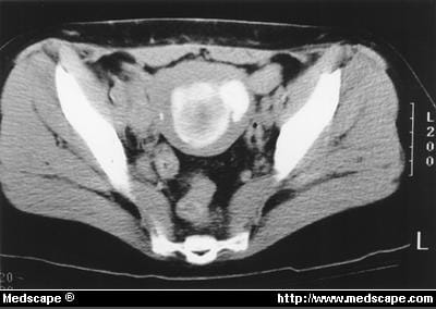 Uterine Artery Embolization for Fibroids: Considerations in Patient ...