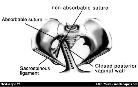 Pelvic Prolapse: Diagnosing and Treating Uterine and Vaginal Vault ...
