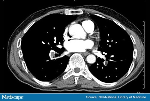 Fall: Junger Mann mit Thorax-Schmerz und Atemnot nach Darm-OP - Page 2