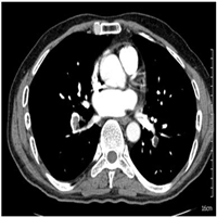 Fall: Junger Mann mit Thorax-Schmerz und Atemnot nach Darm-OP - Page 2