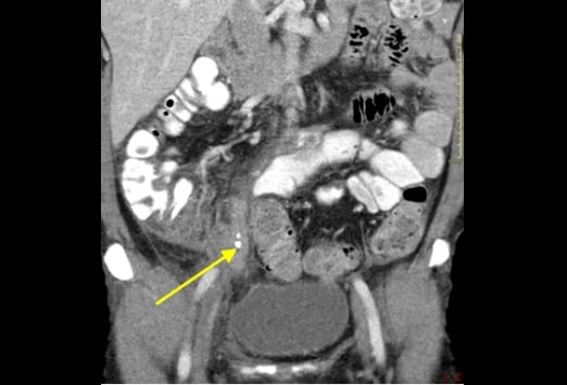 Diagnosestellung einer Appendizitis | Medscape