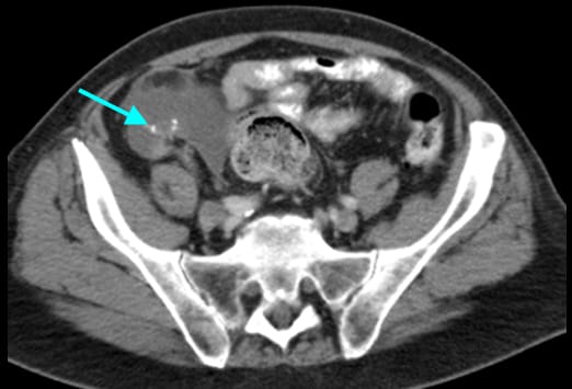 Diagnosestellung einer Appendizitis | Medscape