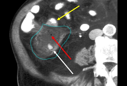 Diagnosestellung einer Appendizitis | Medscape