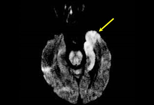Von Tumor bis Migräne: Fünf Fallgeschichten zum organischen Schwindel ...