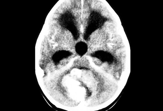 Von Tumor bis Migräne: Fünf Fallgeschichten zum organischen Schwindel ...