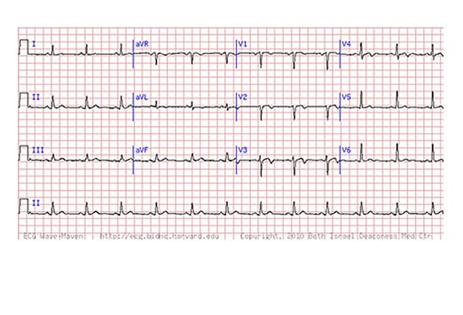 Diskrete Infarktzeichen im EKG | Medscape