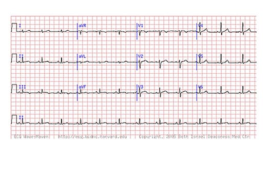 Diskrete Infarktzeichen im EKG | Medscape