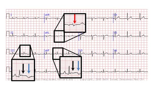 Diskrete Infarktzeichen im EKG | Medscape