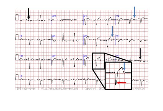 Diskrete Infarktzeichen im EKG | Medscape