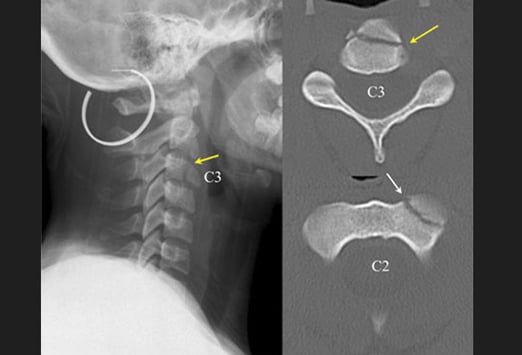 Besser befunden: Typische Diagnosen konventioneller HWS-Aufnahmen ...
