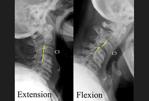 Besser befunden: Typische Diagnosen konventioneller HWS-Aufnahmen | Medscape