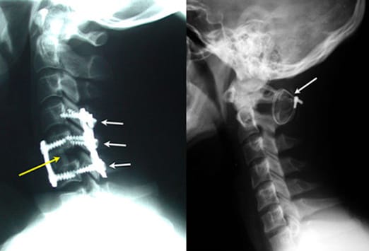 Besser befunden: Typische Diagnosen konventioneller HWS-Aufnahmen ...