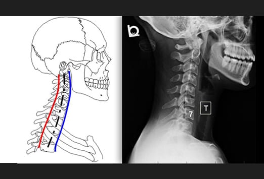 Besser befunden: Typische Diagnosen konventioneller HWS-Aufnahmen ...