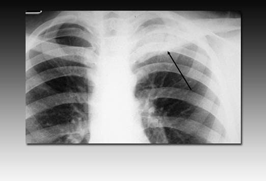 Thoraxröntgen: Das sollten Sie nicht übersehen | Medscape