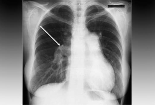 Thoraxröntgen: Das sollten Sie nicht übersehen | Medscape