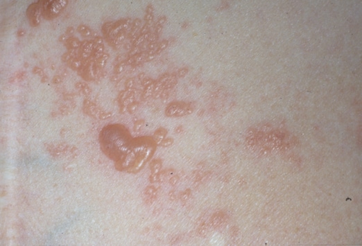 Herpes Zoster-Komplikationen, die man nicht übersehen darf | Medscape