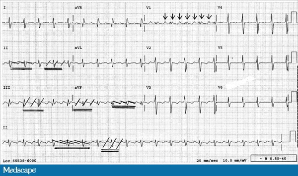 Quiz über EKG | Medscape