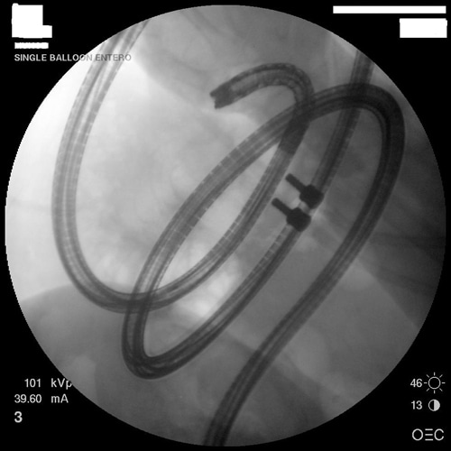 Anämie und rektale Blutung als Zeichen für eine Notfalldiagnose | Medscape