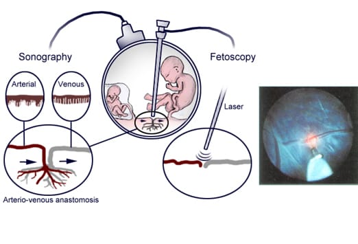 Fetalchirurgie | Medscape