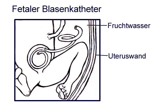 Fetalchirurgie | Medscape