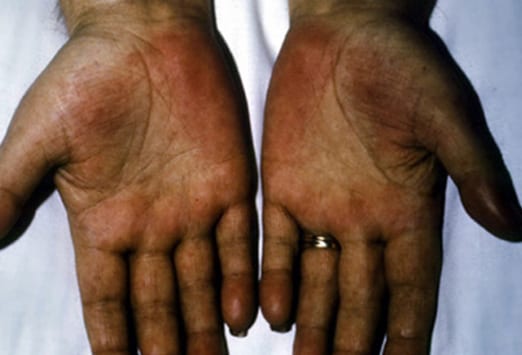 Raynaud-Phänomen, Palmarerythem bei einem Hepatitis C-Virus infizierten ...