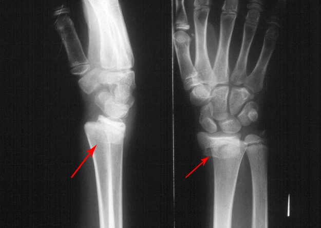 Spontankorrektur von distalen Radiusfrakturen bei Kindern | Medscape