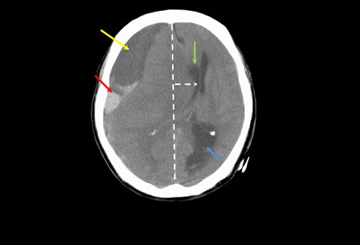CT-Schädel-Quiz: Erkennen Sie alle Befunde? | Medscape
