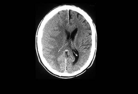 CT-Schädel-Quiz: Erkennen Sie alle Befunde? | Medscape