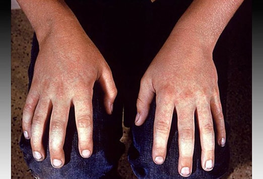 Pusteln, Papeln, Erytheme: 15 Hauterscheinungen, die Sie kennen sollten ...