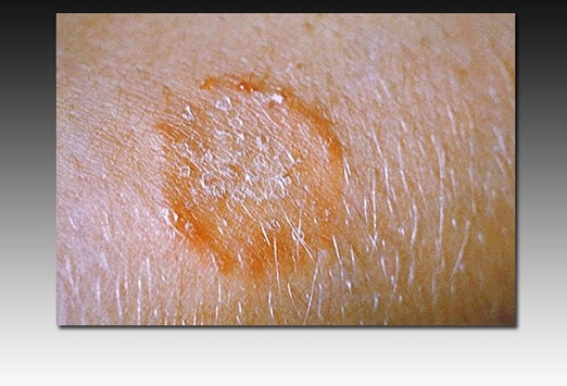 Pusteln, Papeln, Erytheme: 15 Hauterscheinungen, die Sie kennen sollten ...